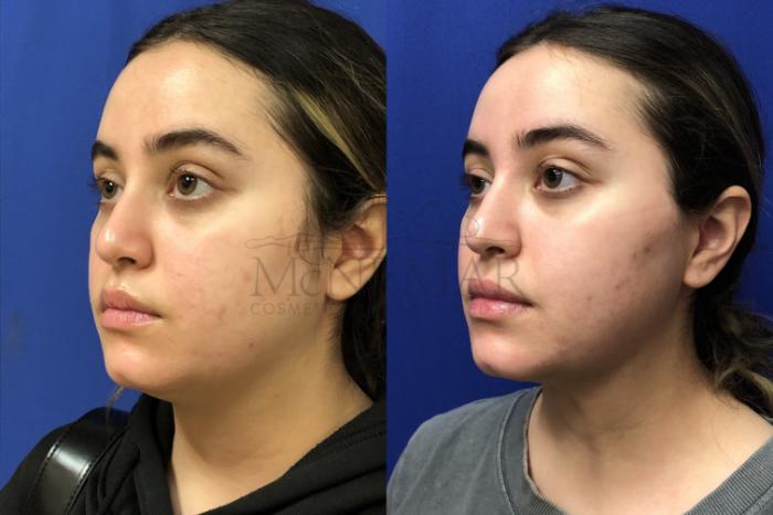 Liposuction Before & After Photo Gallery | San Ramon & Tracy, CA ...